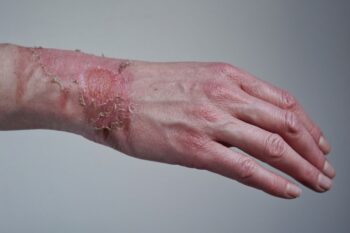 What Are Skin Substitutes? Advanced Wound Care Solutions Explained